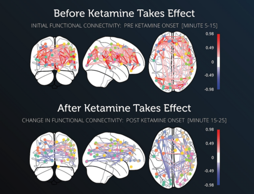 Anti-Aging Biohacker Bryan Johnson’s Ketamine Experiment - HealingMaps
